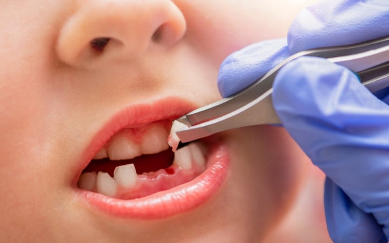 Preventing Bone Loss After Tooth Extraction